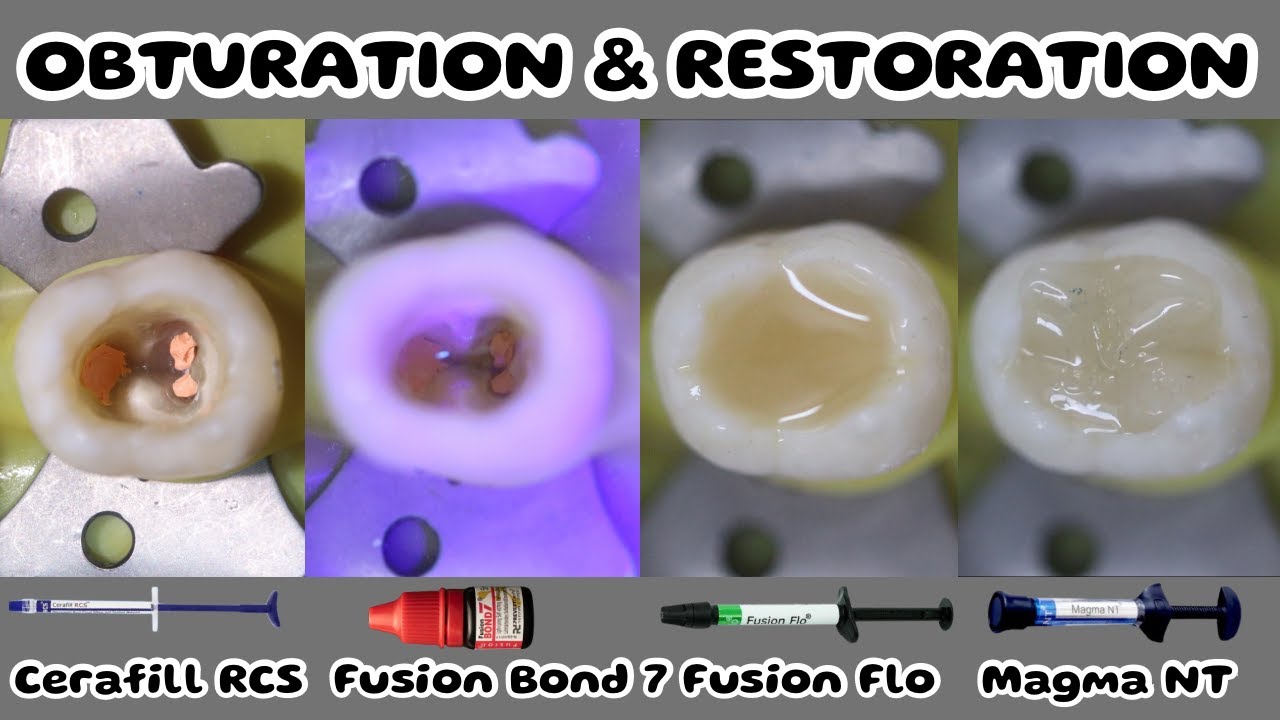 Obturation with Cerafill RCS ⚪️ PostObturation Restoration 🔵 fusion ...