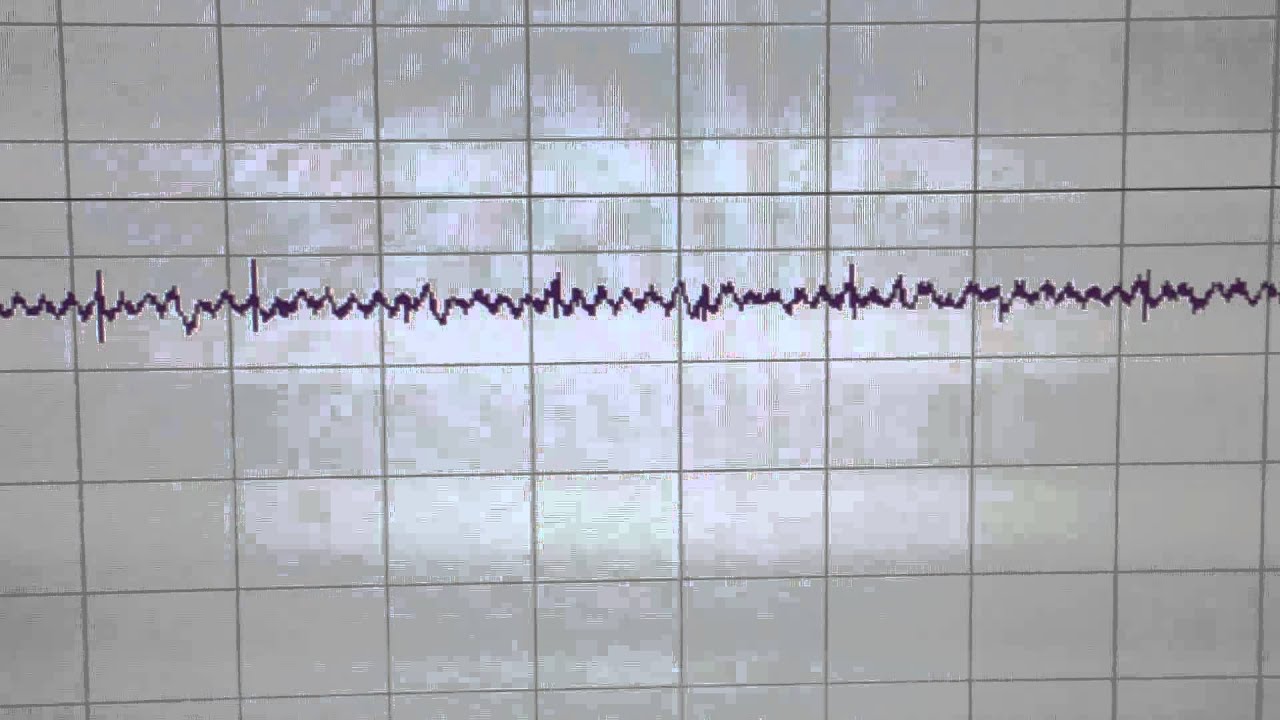 Dive bomber response on EMG - YouTube