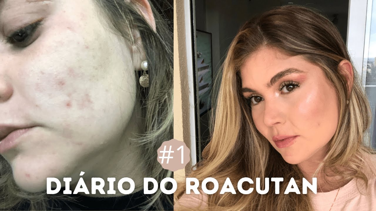 Minha história com ROACUTAN | 45 dias de tratamento de acne - Fotos ...