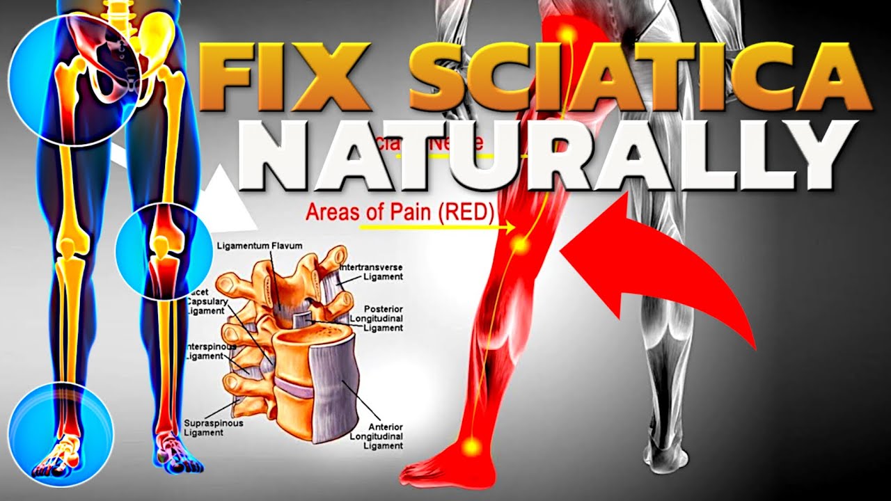 Finally A Natural Way To RELIEFE SCIATICA Pain, Fix Sciatica Naturally ...