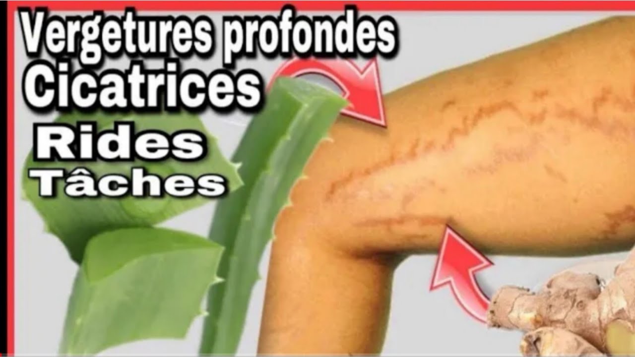 OMG Gomme Vergetures Rides, EXFOLIE Peaux sèches, ENFIN la solution à ...
