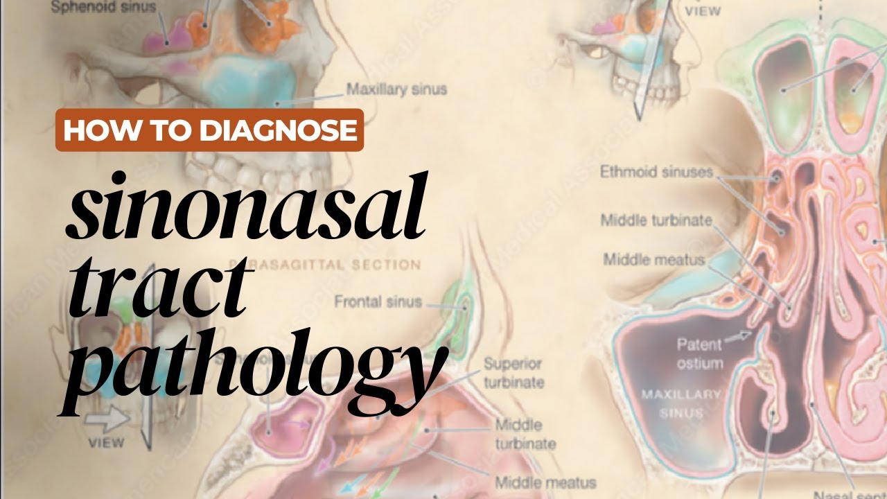 How to diagnose Sinonasal tract pathologies and tumours : an easy ...