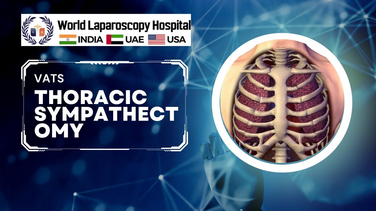 Understanding Thoracic Sympathectomy - YouTube
