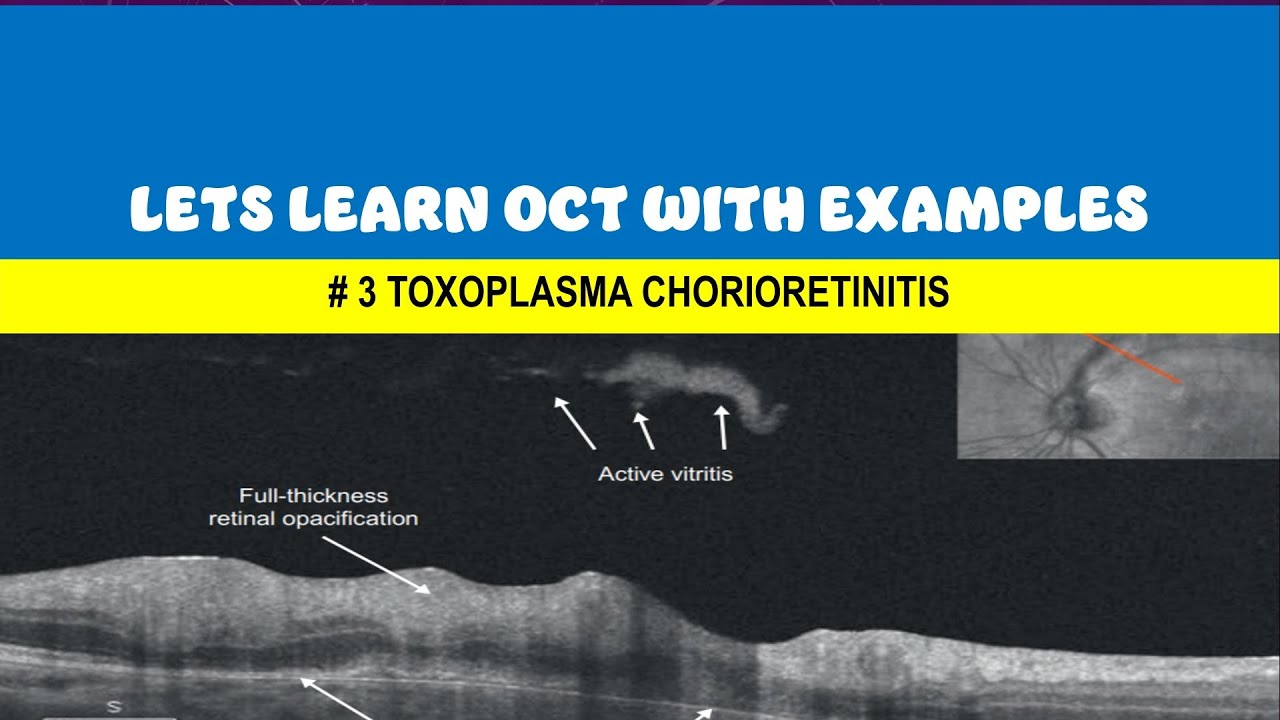 LETS LEARN OCT | #3 toxoplasma chorioretinitis - YouTube