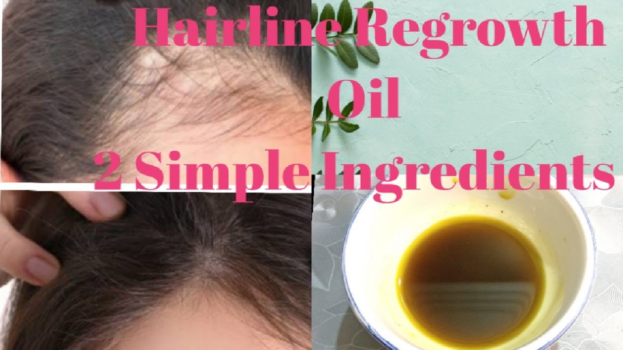 Oil To Cure Baldness And Stop Thinning Hair// Hairline Regrowth Oil 2 ...