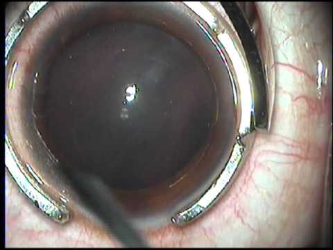 ICL(Implantable collamer lens) surgery - Dr Sajid Ahmed Hyderabad India ...