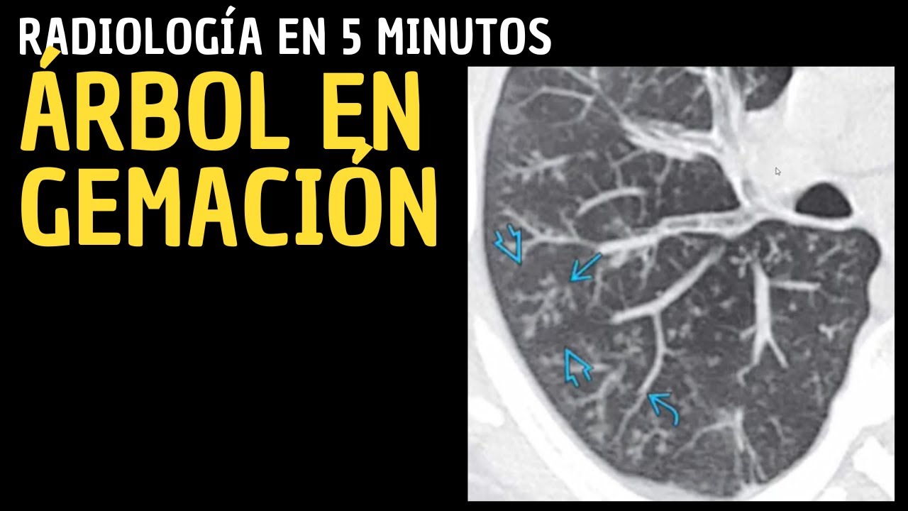 Radiología en 5 minutos: Signos radiológicos pulmonares: Árbol en ...