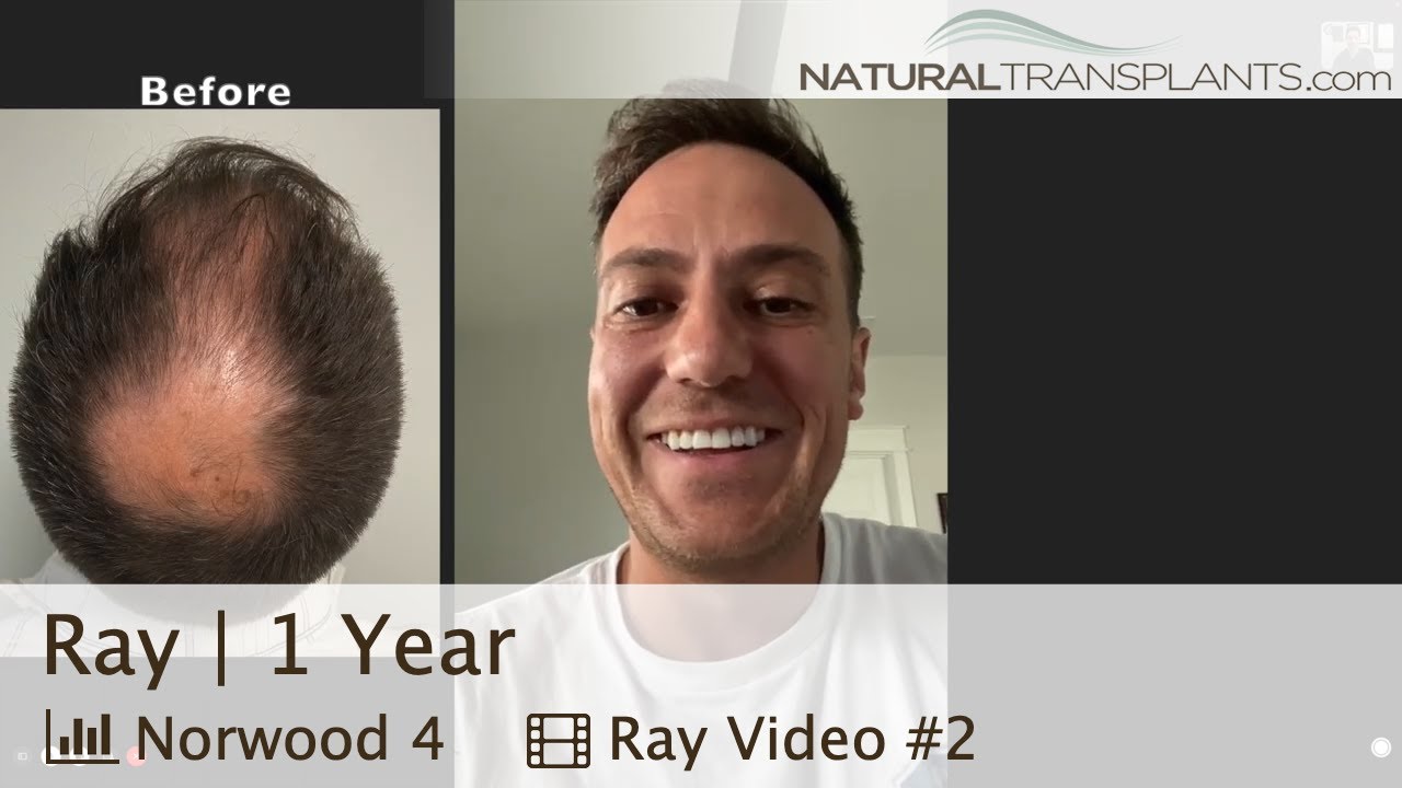 Natural Hair Transplants Increases Density by 30-40% with Hair ...