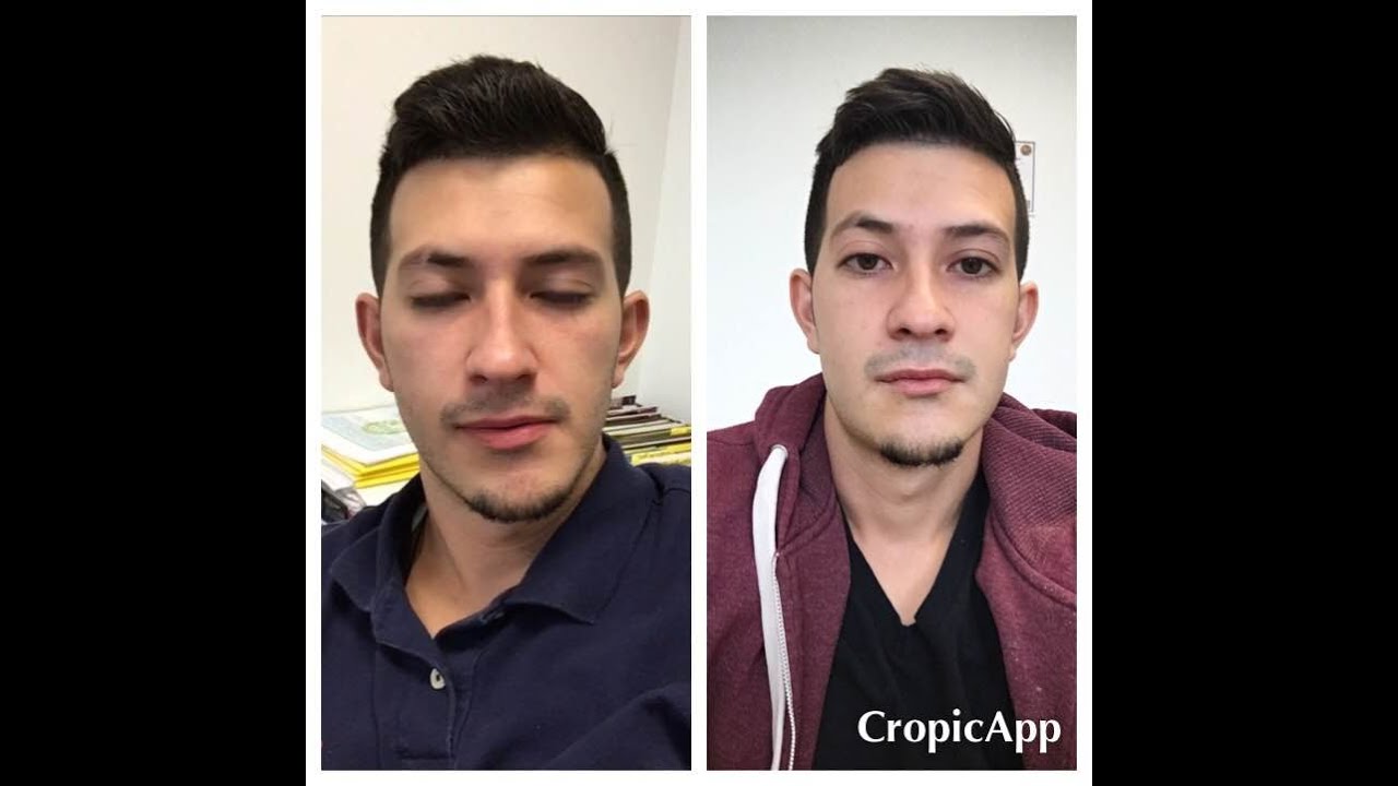 What you need to know before double jaw surgery- before and after - YouTube