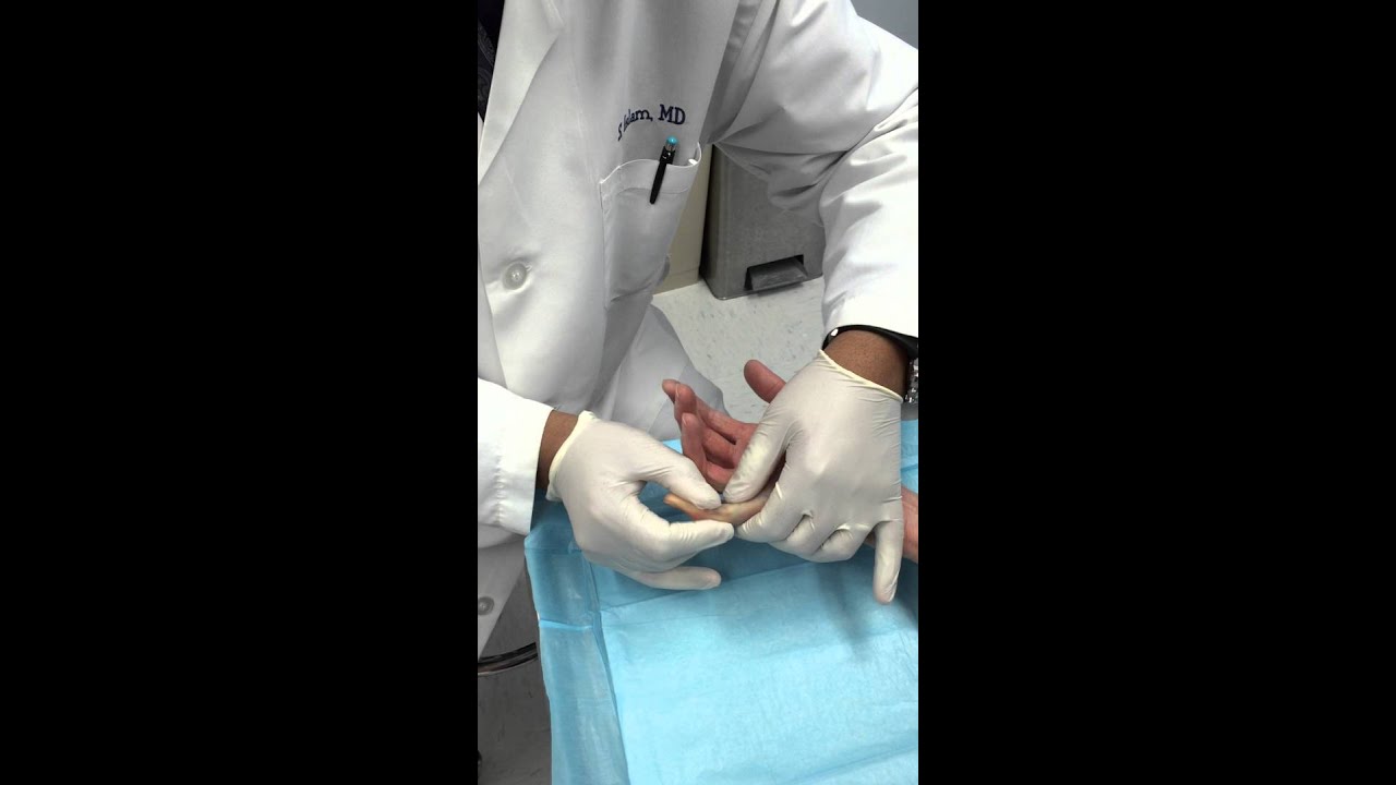 Second Stage - Xiaflex® Treatment for Dupuytren's Contracture - YouTube