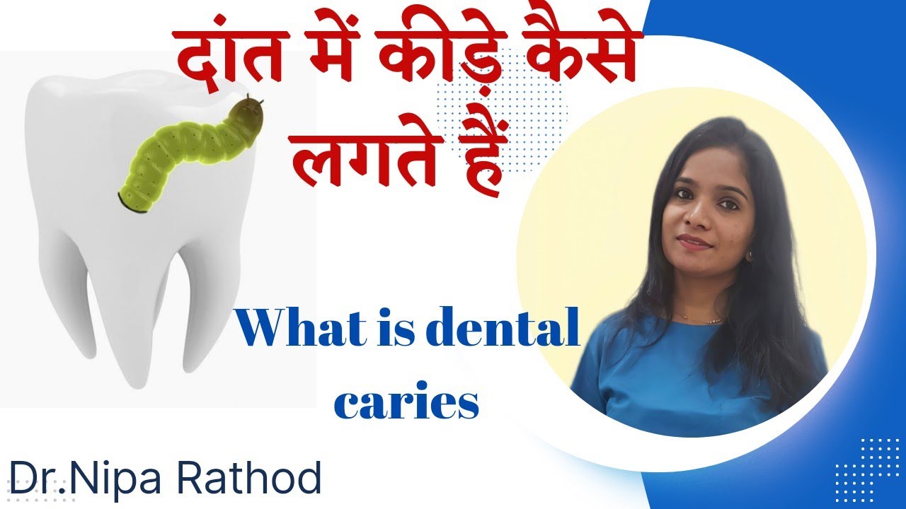 दाँत का कीड़ा | दाँत में सडन कैसे लागती हैं ? what is dental caries ...