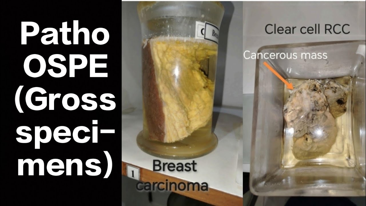 Gross Specimens (imp.) for 4th Year Pathology OSPE - YouTube