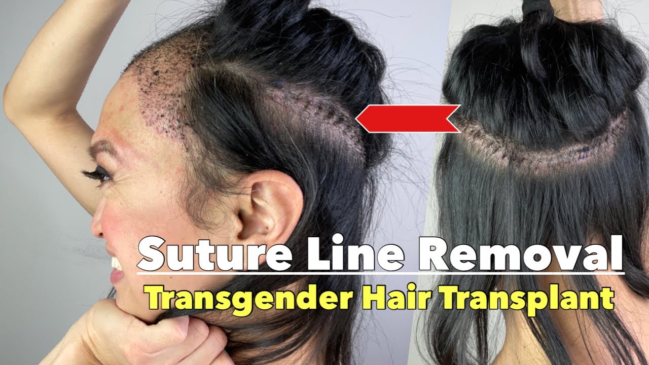 WHEN TO REMOVE YOUR SUTURE LINE | TRANSGENDER HAIR TRANSPLANT - YouTube
