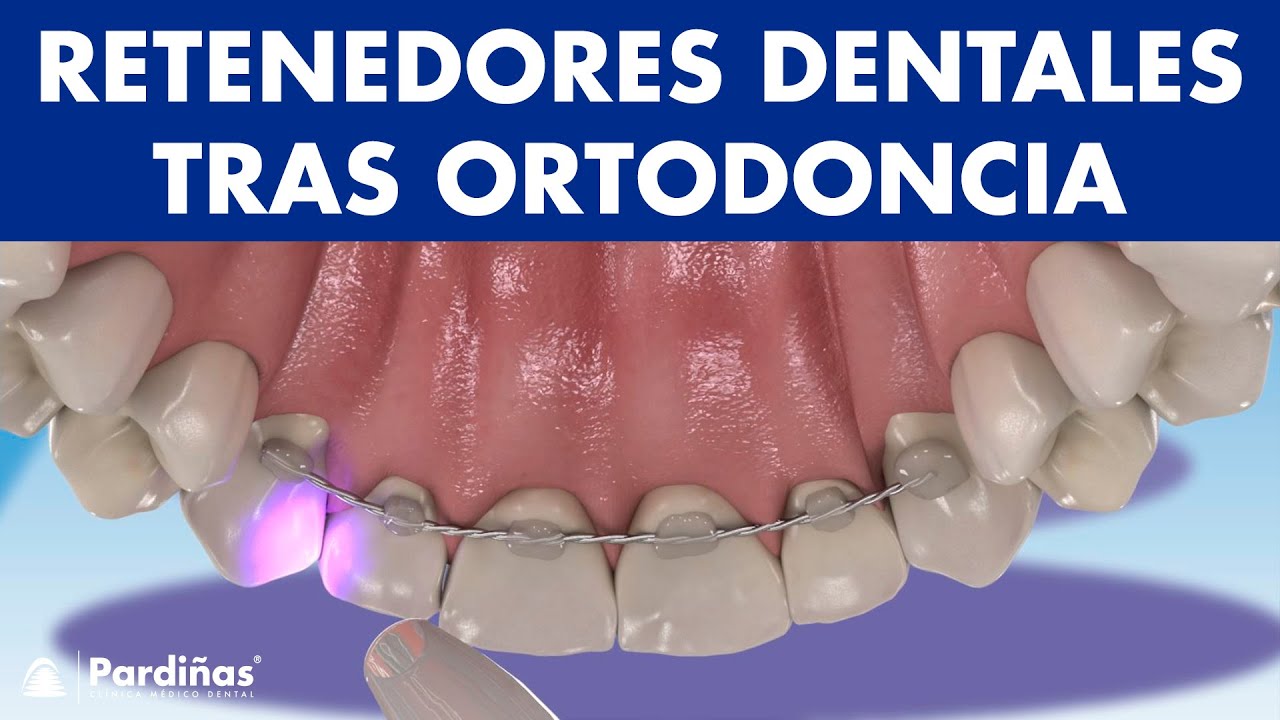 RETENEDORES DENTALES - Cómo evitar que se muevan los dientes tras la ...