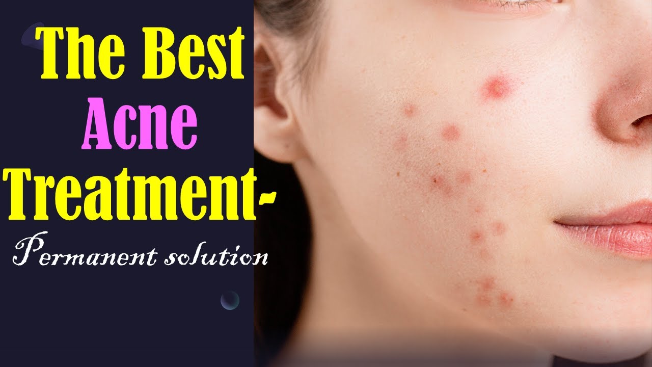 Acne Causes and it's Natural treatment for permanent solution. - YouTube