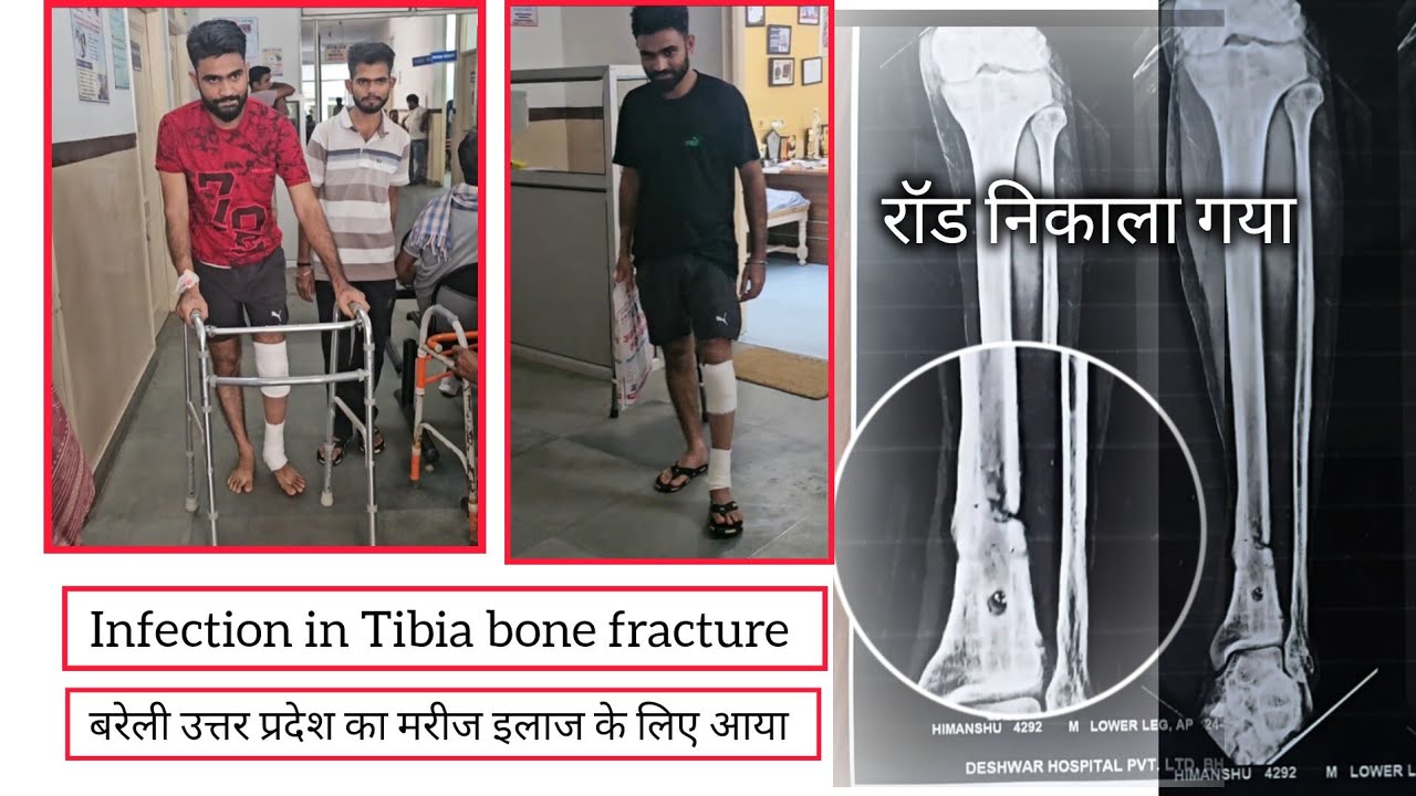 Nail Removed:- Infection in Tibia fibula bone fracture # ...
