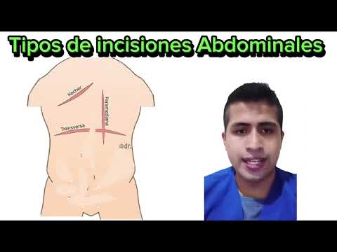 Tipos de incisiones Abdominales - YouTube