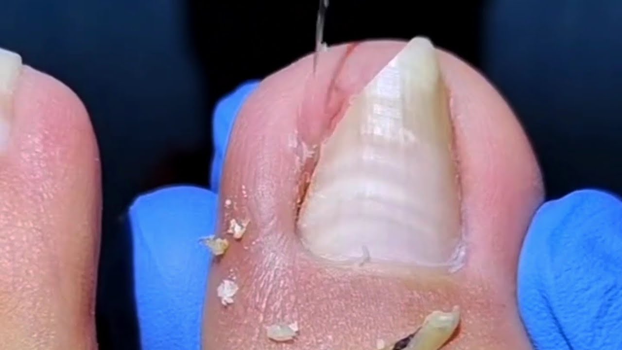 Toenail Is Sharp As Spear! Trim and Dig Out Ingrown Toenails - YouTube