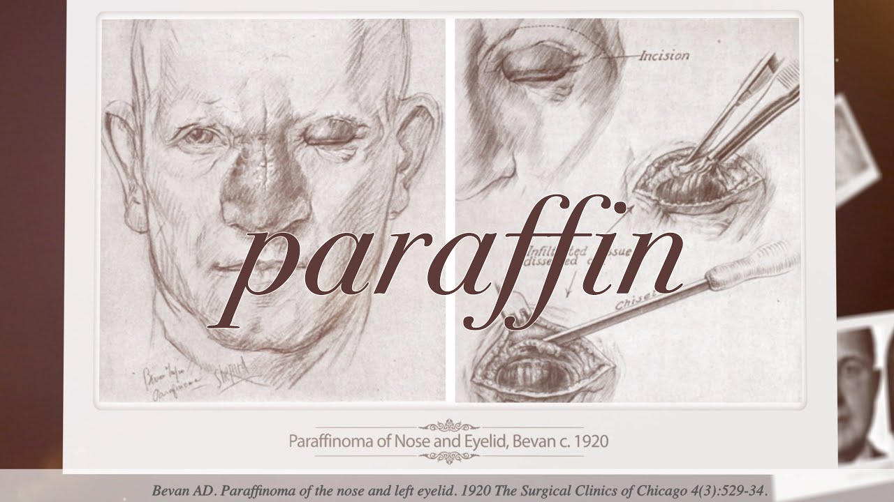 History of Cosmetic Fillers: Paraffin | Aesthetic Minutes # ...