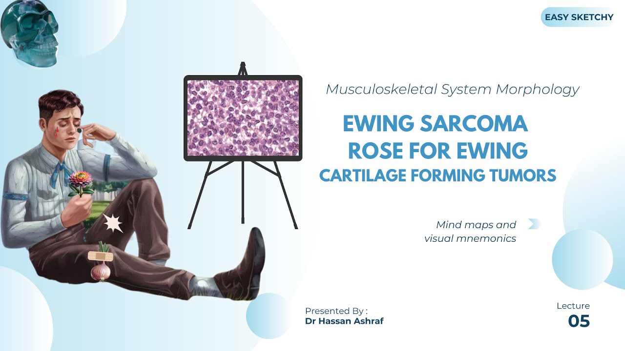 Ewing Sarcoma Pathology | Chondroma | Super simplified pathology ...