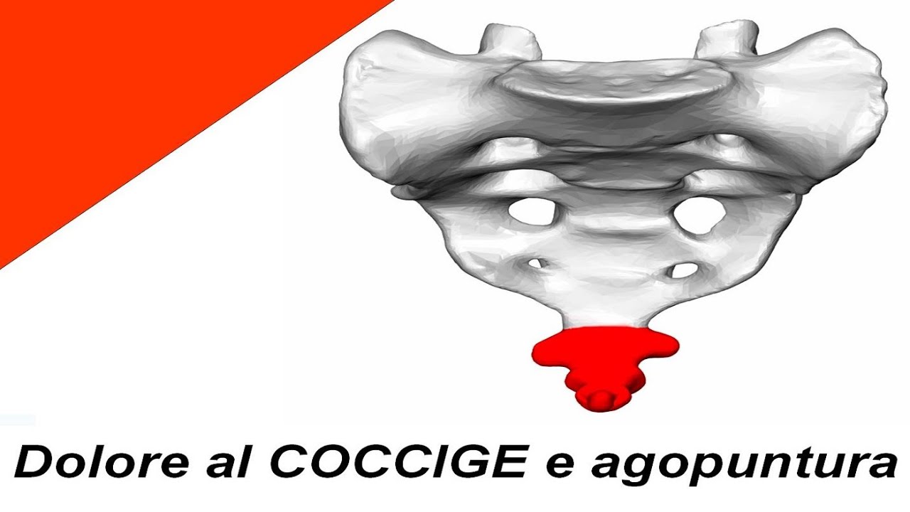 Dolore al coccige agopuntura, dolore al sacro agopuntura , osso sacro ...