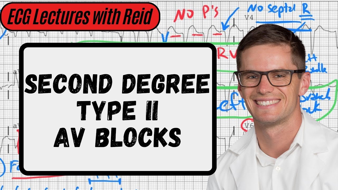 2nd Degree Type II AV Blocks | Day 6 ECG Challenge - YouTube