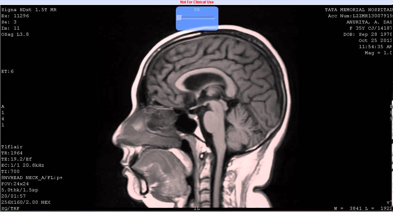 Sag T1 Flair 25-Oct-2013 - YouTube