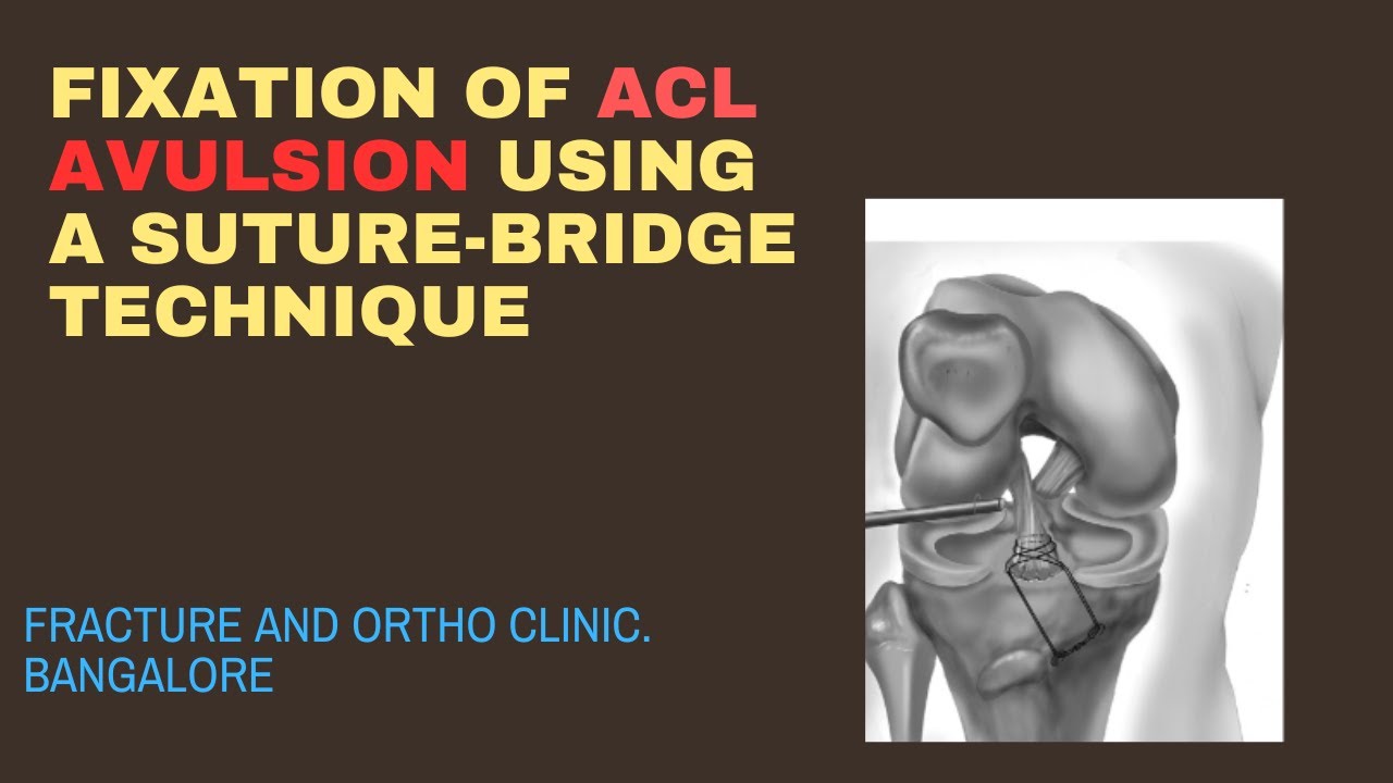 ACL avulsion reattachment - Suture bridge technique with two 4.5 mm ...