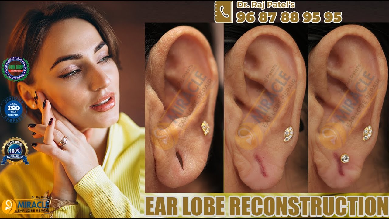 Ear Lobe Repair / Ear Holl Repair / Torn Ear Repair / Ear Pasting ...