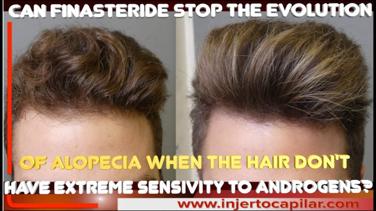Can finasteride stop the evolution of AGA when the hair don’t have ...