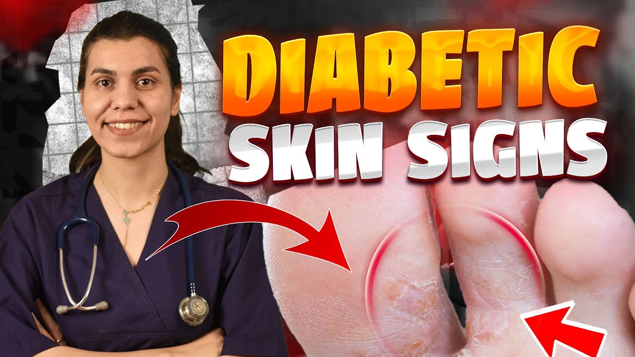 Diabetic Skin Problems & Top Signs of Diabetes on The Skin! - YouTube
