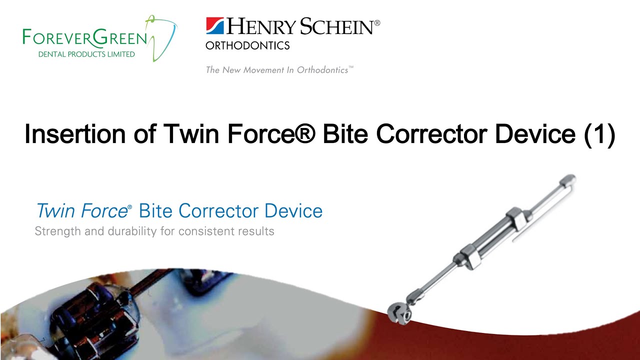 Insertion of Twin Force® Bite Corrector Device (1) - YouTube