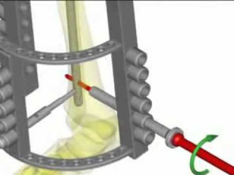 Haste Bloqueada Tibial - Hexagon - YouTube