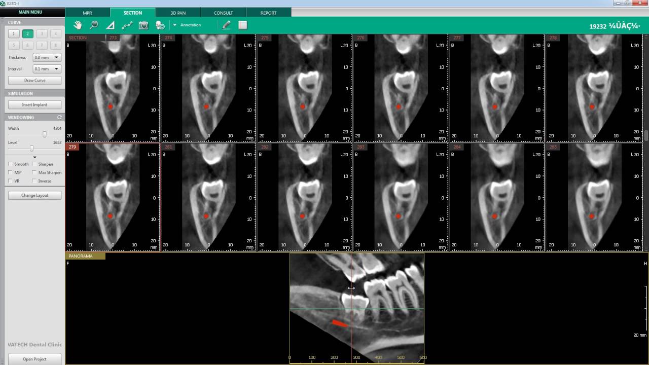 03 3rd Molart Diagnosis #48 Extraction Case Description - YouTube