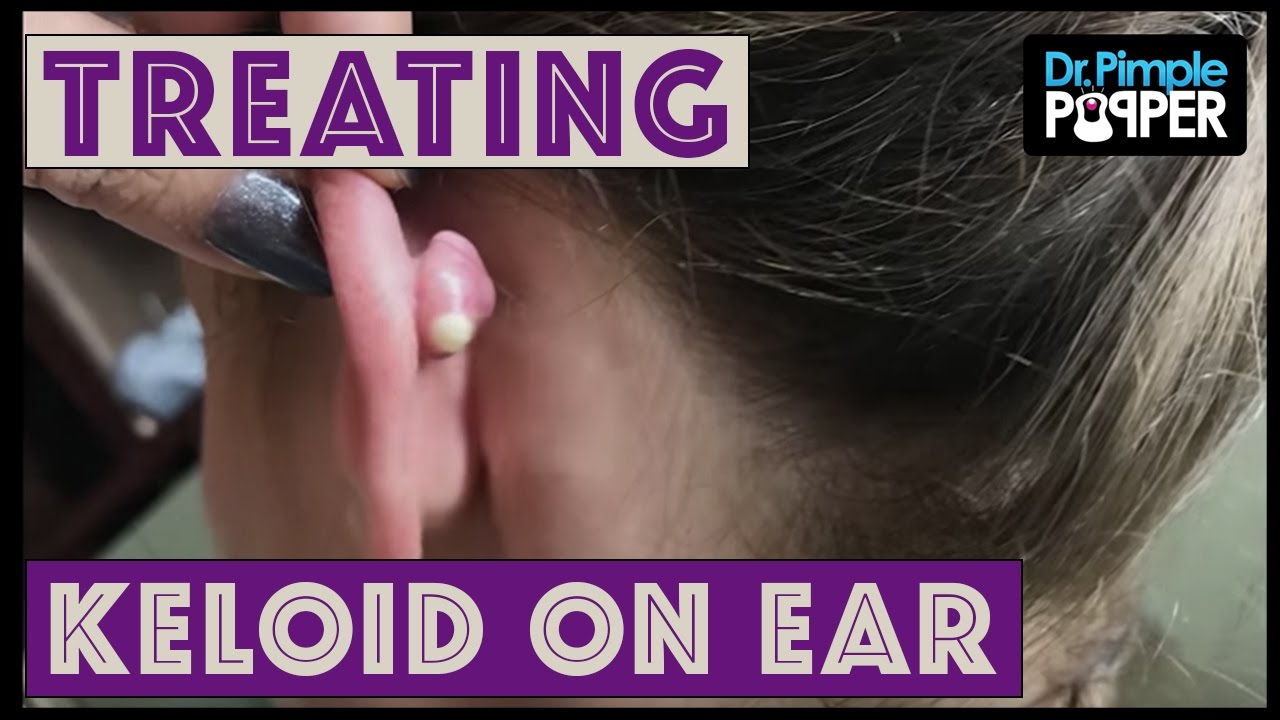 A Cute Keloid Treated with Cryoshape - YouTube