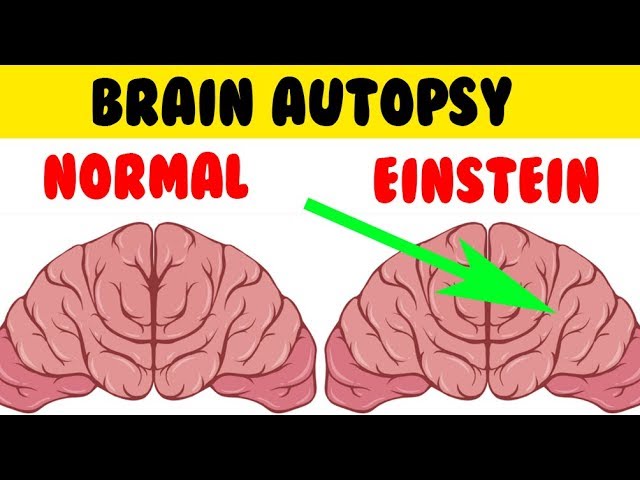 Albert Einstein Brain Vs Normal Brain