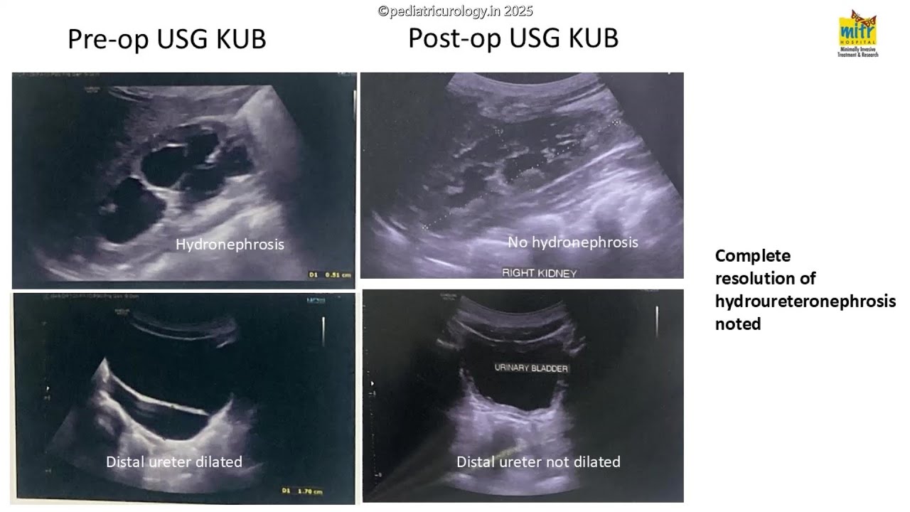 Ureteric reimplantation for primary obstructive megaureter in a child ...