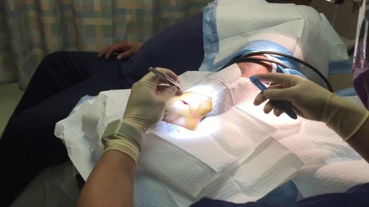 Extensor Tendon Injury: Extending a Wound Margin - YouTube