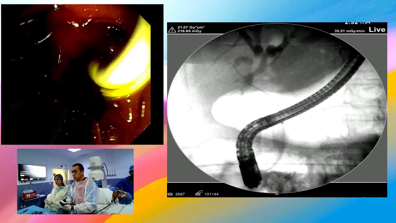 ERCP for severe acute cholangitis. - YouTube