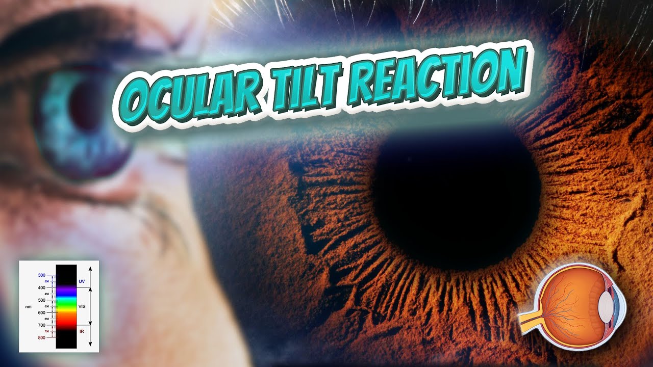 Ocular tilt reaction - Your EYEBALLS - EYNTK 👁️👁️💉😳💊🔊💯 - YouTube