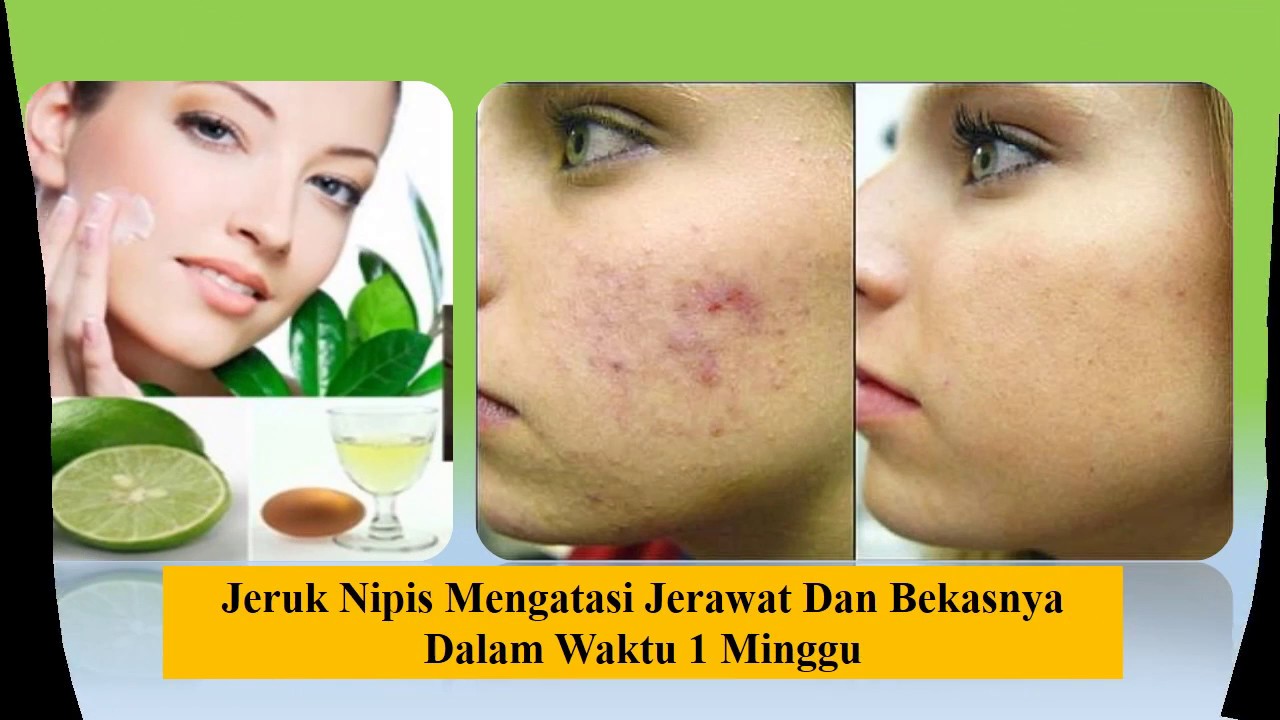 Jeruk Nipis Atasi Jerawat Dan Bekasnya Dalam Waktu 1 Minggu - YouTube
