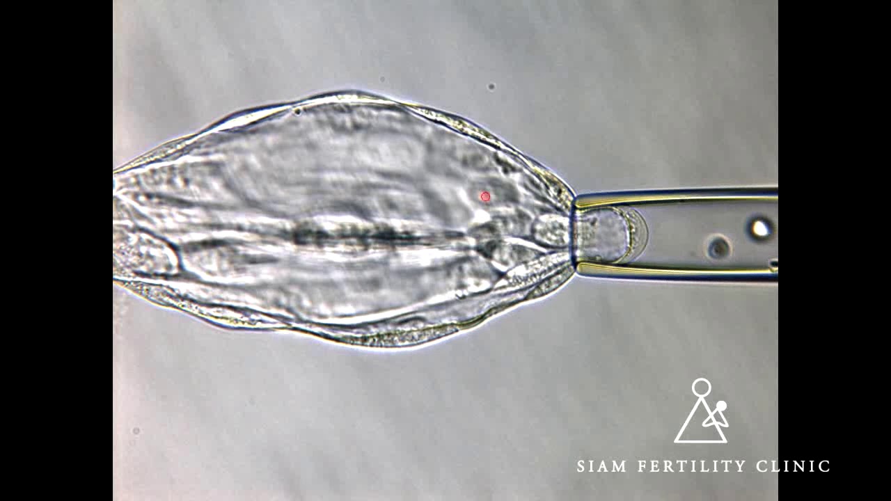 Biopsy Blastocyst Youtube