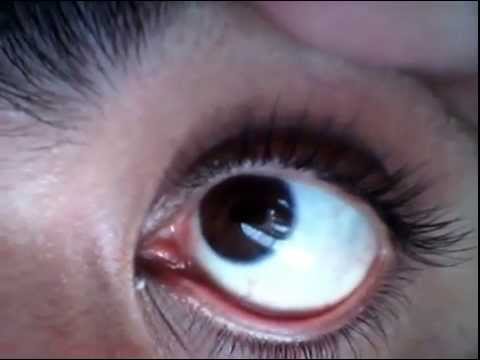 OMG Taking stone from Eyes - YouTube