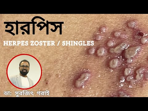 হারপিস । HERPES ZOSTER | SHINGLES |Dr Surajit Gorai