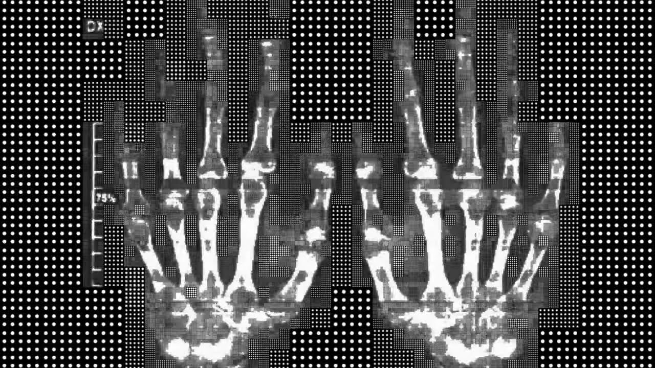 HAND AND FOREARM I CARPAL TUNNEL I RIFE Frequency No. 2008CAFL - YouTube