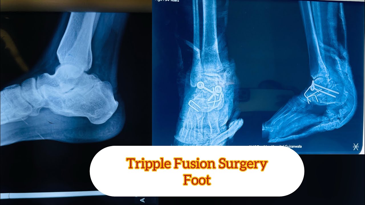 Tripple Fusion Surgery Foot - YouTube