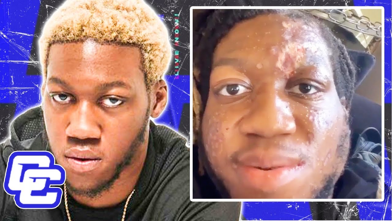 OG Maco Talks About Living With A Flesh-Eating Disease - YouTube