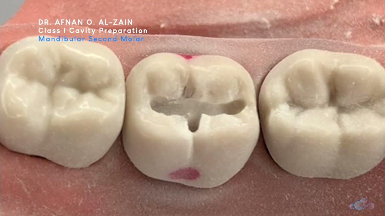 Class I cavity preparation for amalgam - mandibular molar #47 - Preclinical Operative - Arabic ...