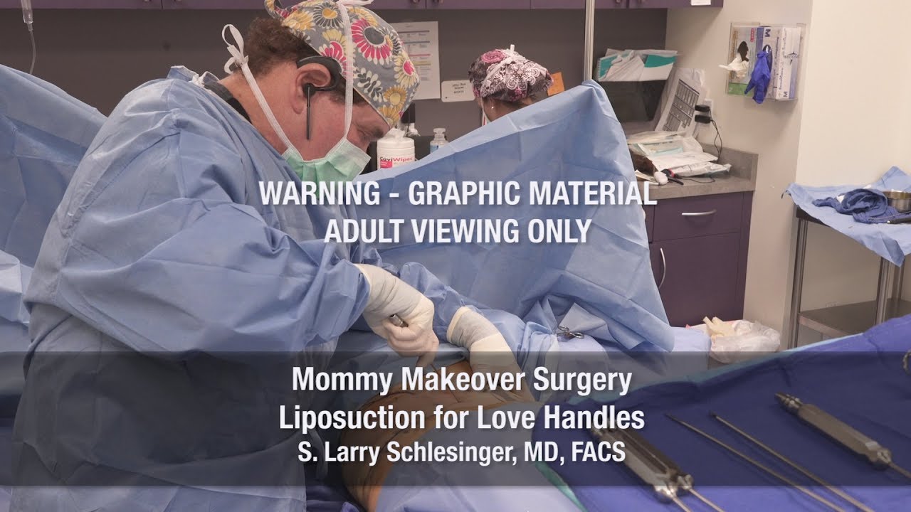 Love-Handle Fat Removal Using Liposuction - Plastic Surgery Video Demo ...