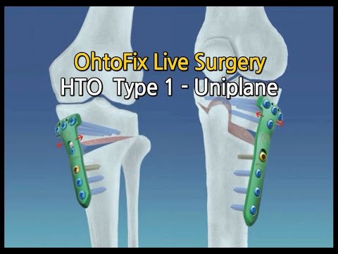 Ohtofix HTO Type 1 - Uniplane (Live Surgery) - YouTube